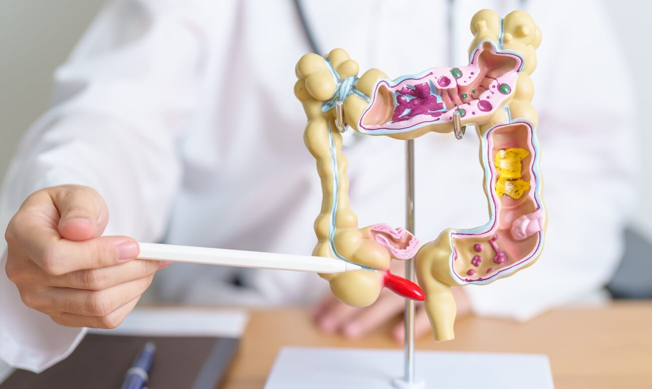 ¿Cómo Identificar que Tengo Síndrome del Intestino o Colon Irritable ...